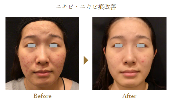 ダーマペン4 | フォーシーズンズ美容皮膚科クリニック東京院｜東京・銀座