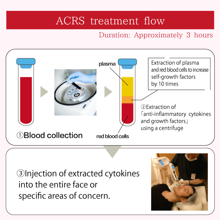 ACRS therapy（skin regeneratioin therapy) | フォーシーズンズ美容皮膚科クリニック東京院｜東京・銀座